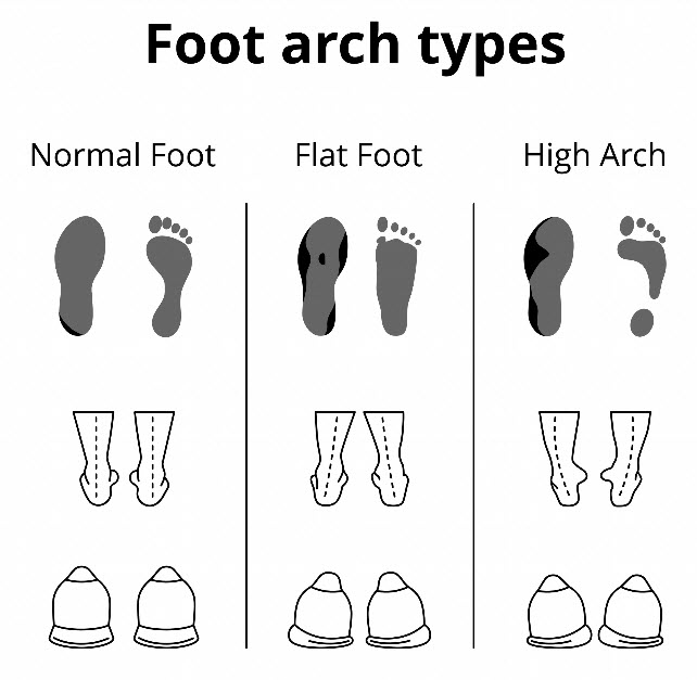 Foot Arch Types Foot Leg Centre